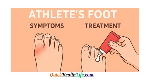 Athletes Foot Overview Symptoms Causes Types Diagnosis Treatment