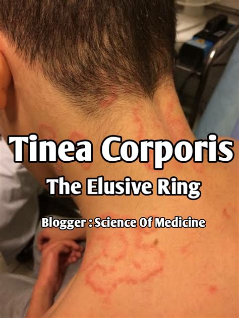 Science Of Medicine Understanding Tinea Corporis Causes Symptoms