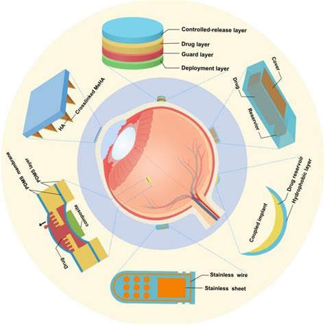 Implantable Sustained Release Drug Delivery Systems A Revolution For