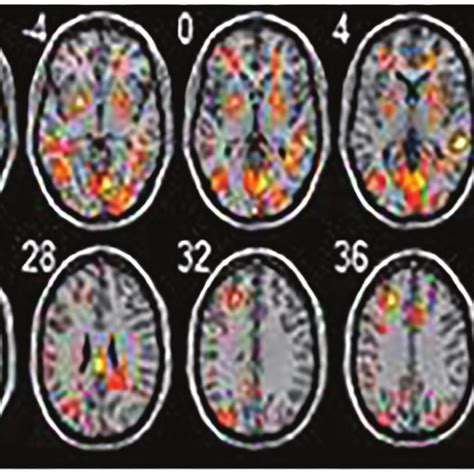 Regions Where Homogeneity Decreased In The Amnestic Mild Cognitive