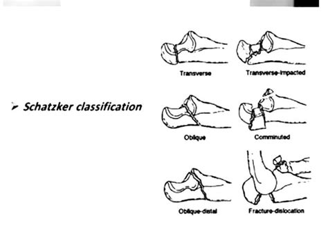 Olecranon Fracture Anatomy Clinical Picturepptx