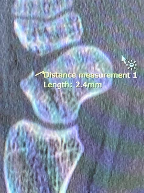 Scaphoid Fracture Does This Need Surgery Rbrokenbones