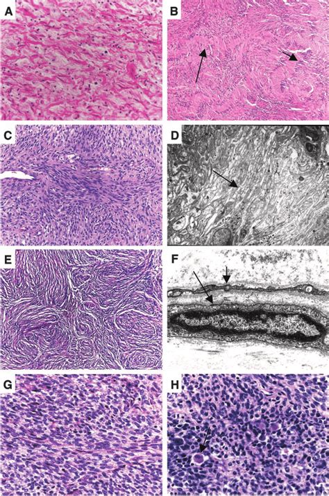 Pathology Of Human Peripheral Nerve Sheath Tumors A Neurofibroma