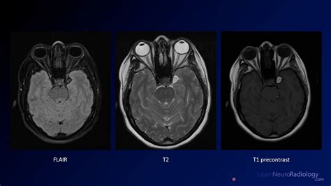 Dermoid Tumor Brain Mri