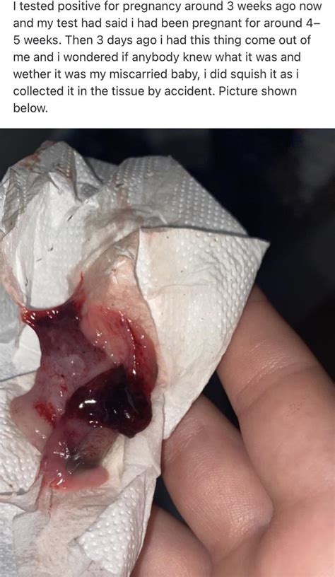 Miscarriage Tissue At 4