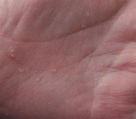 Punctate Keratosis