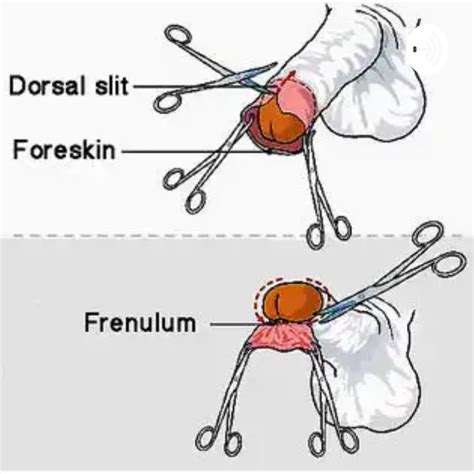 Men And Circumcision Podcast Apple Podcasts