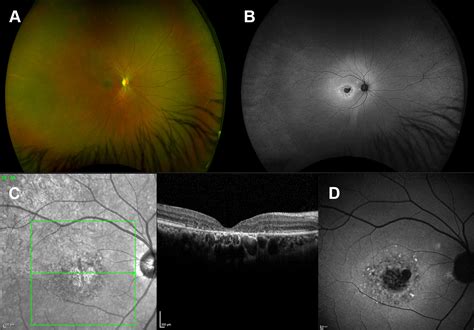 Abca4 Retinopathy For Professionals Gene Vision