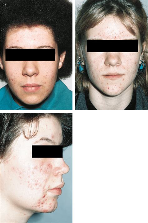 Acne Grading Scale I Mild Ii Moderate And Iii Severe Download