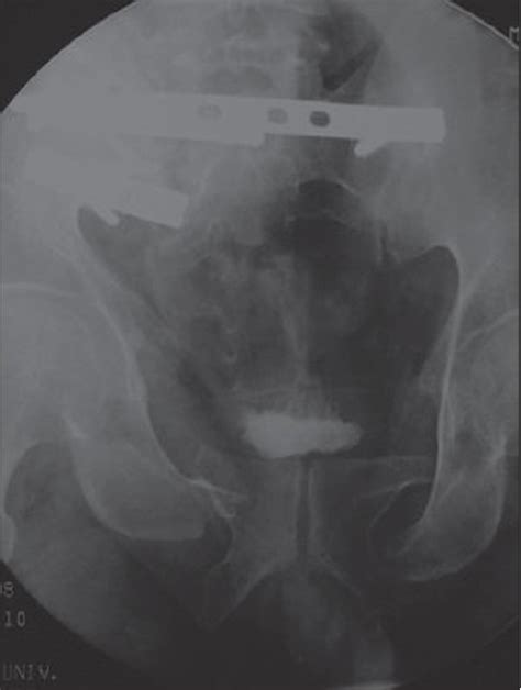 Voiding Cystourethrography3 Months After Catheter Removalshowing