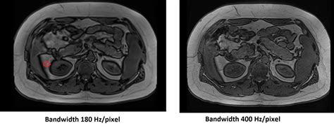 Chemical Shift Artifact Mri