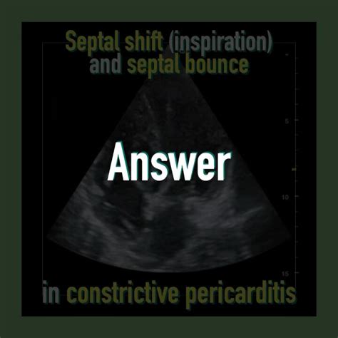 Martin Altersberger On Linkedin Septal Shift Ias Bounce