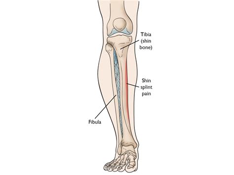 Shin Splints Podiatry Quest