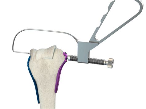 Elbow Plating System Acumed