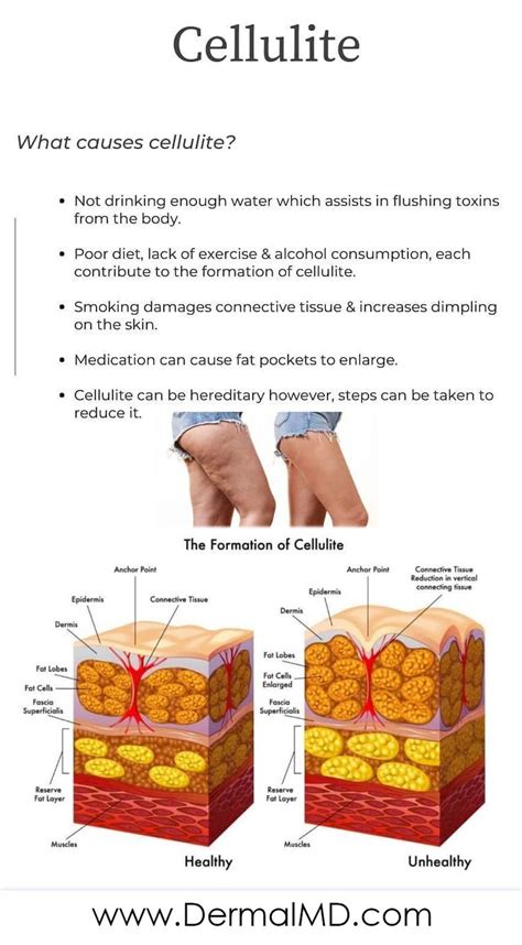 Cellulitis System Disorder Template System Disorder Rachel Vance