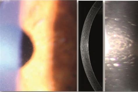 Case Studies Fuchs Endothelial Dystrophy