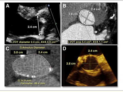 Figure 1 From Imaging Of Low Gradient Severe Aortic Stenosis Semantic Scholar