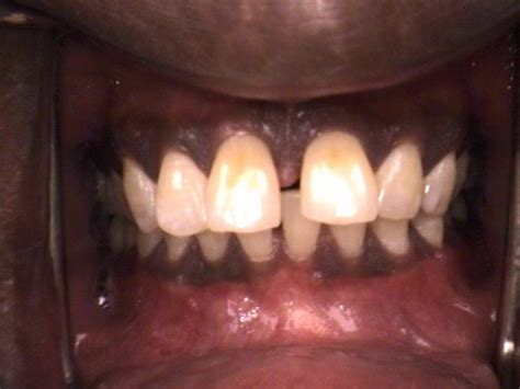 Lead Poisoning Gums