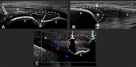 Reliability Of A Consensus Based Ultrasound Definition And Scoring For