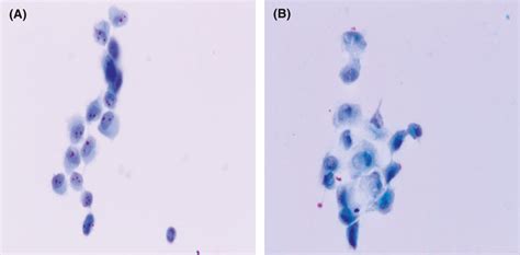 A Atypical Cells With Inconspicuous Nucleoli Speculated As Neoplastic Download Scientific