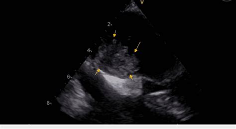 Transthoracic Echocardiography Showing A 2 Cm X 2 1 Cm Mobile Mass In