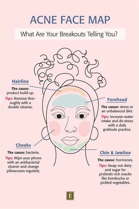 Acne Face Map What Are Your Breakouts Telling You Artofit