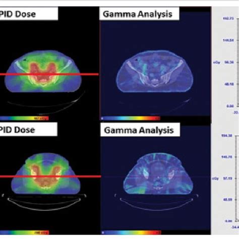 Calculated Dose Measured Dose Gamma Evaluation And Line Dose