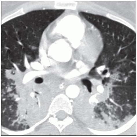 Aspiration Radiology Key