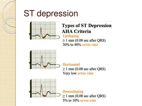 Ppt Ecg Interpretation For Beginners Part 4 Acute Coronary