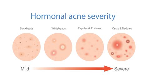 Hormonal Acne Symptoms And Treatment Aurora Health Care