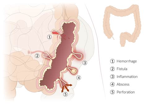 Diverticulosis Bleeding