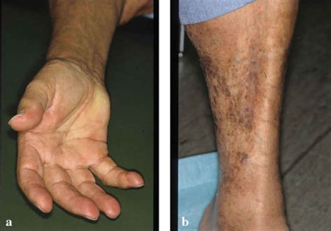 Nephrogenic Systemic Fibrosis Images