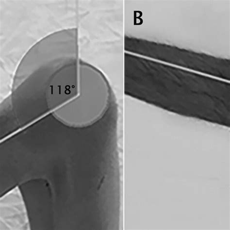 Improvement Of Popliteal Angle With Hyper Selective Neurectomy In An
