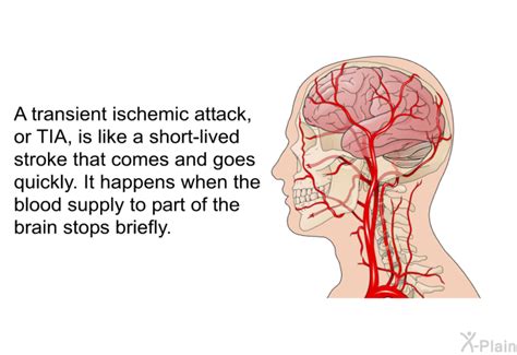 Tia Transient Ischemic Attack