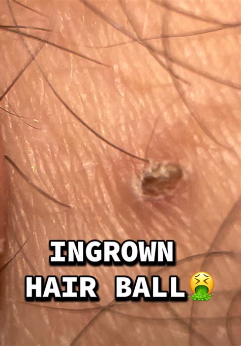 Ingrown Hair Scrotum Ingrown Pubic Hair Treatment And Prevention