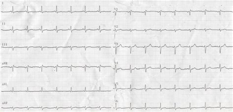 Example Of A Full 12 Lead Electrocardiogram Ecg Download Scientific Diagram