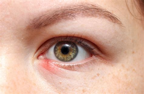 Can You Wear Contacts With A Stye Minneapolis Can You Wear Contacts With A Stye Minneapolis