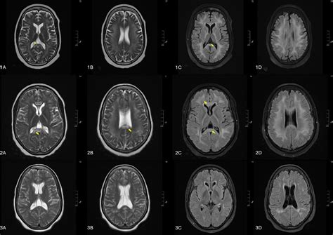 Combined Central And Peripheral Demyelination In Two Siblings Immune