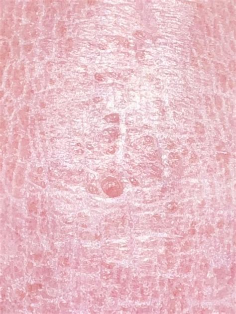 Are These Bumps From Balanitis Rbalanitis