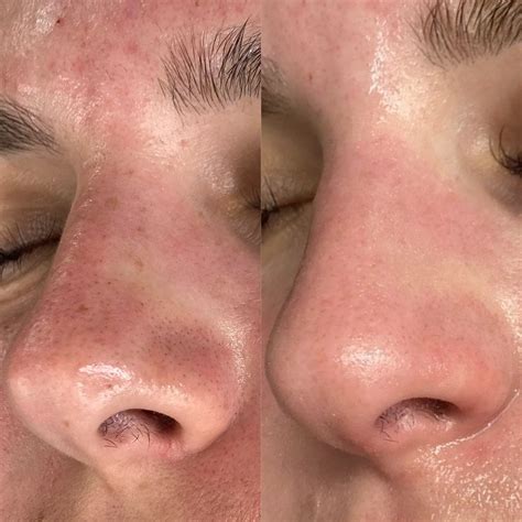 Blackheads On Forehead Removal