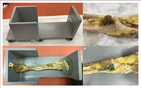 Figure 1 From The Influence Of Sagittal Deformity Of The Distal Radius
