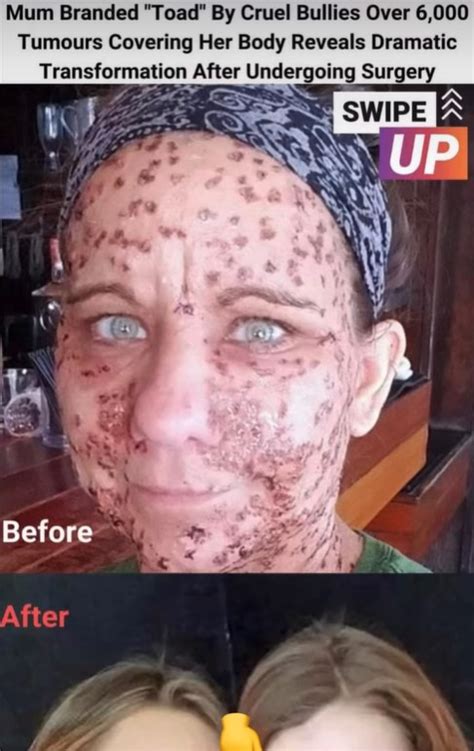Mum Branded “toad” By Cruel Bullies Over 6000 Tumours Covering Her