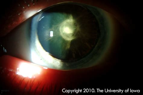 Posterior Polar Cataract Ophthalmology The
