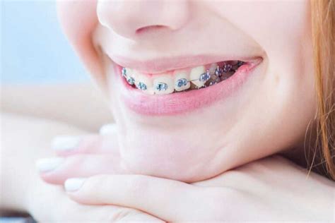 Orthodontics Australia What Is An Ideal Bite