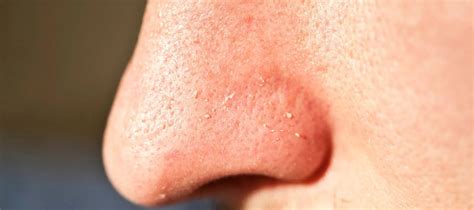 Clogged Pores On Nose Meaning Causes Treatment The Pink Foundry