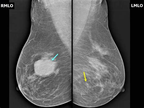 Examples Of Benign Left And Malignant Right Masses In Mammograms