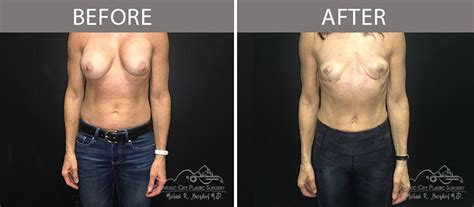 Patient 90705130 Capsulectomy Before And After Photos Music City