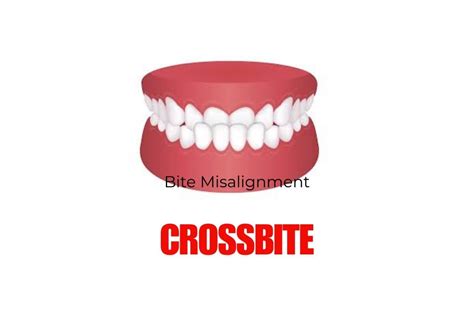 What Happens If A Crossbite Is Not Corrected