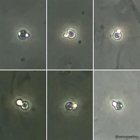 Rather Strange Acanthocytes In Highly Concentrated Urine Of A Patient With Sepsis Phase