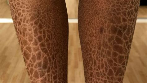 Scaling Skin Pictures Causes Diagnosis And Treatment
